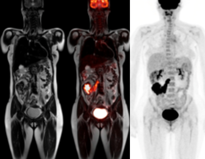 PET/MRI - MRC