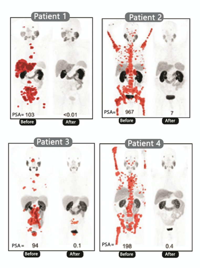 THERANOSTICS in Prostate Cancer - MRC