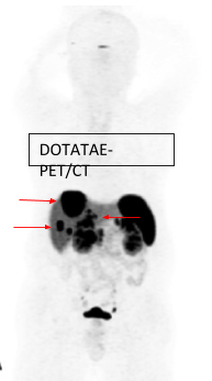 GALLIUM-DOTATATE PET/CT المسح الذرى لأورام الغدد الصماء العصبية - MRC