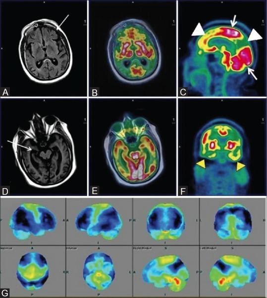 PET/MRI - MRC